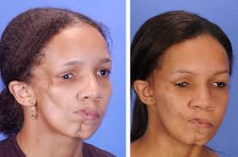 Sindrome di parry romberg, tutto quello che devi sapere - OpenGeoData